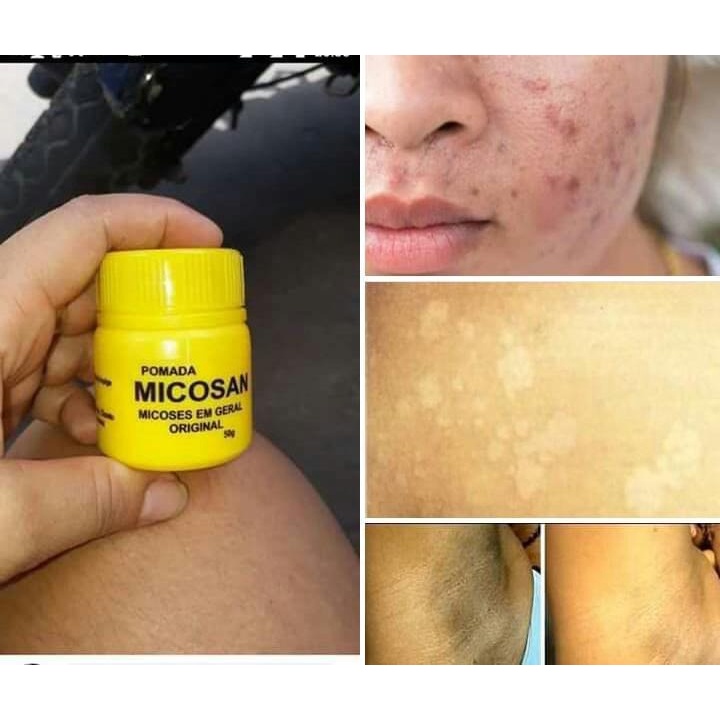 Pomada Micosan 50g, creme para manchas e estrias Original de Fábrica ...