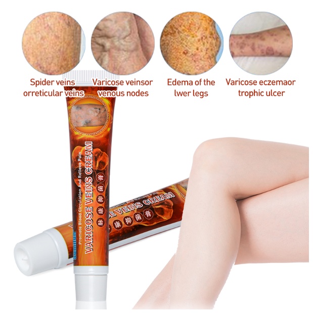 Creme Pomada Para Varizes Tratamento Veias Vasinhos Nas Pernas | Shopee Brasil