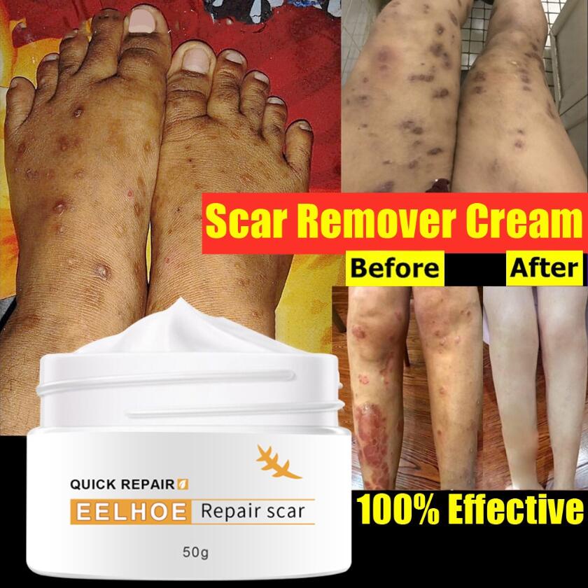 Removedor De Cicatriz Antiga Para Pernas 50g Peklat Acne Gel Creme De ...