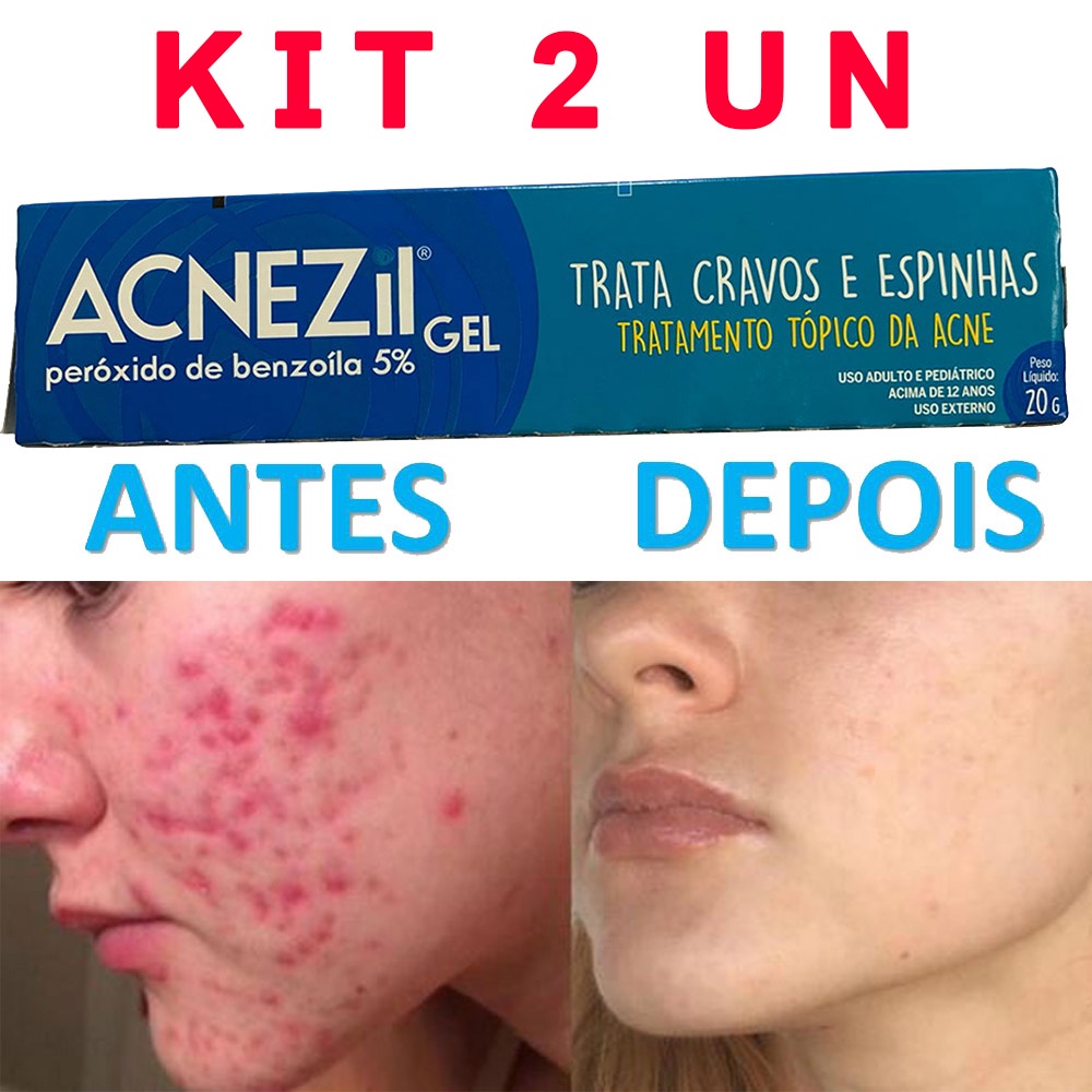 Kit 2 Pomada Acnezil Gel 20g Tratamento Para Cravos Espinhas | Shopee ...