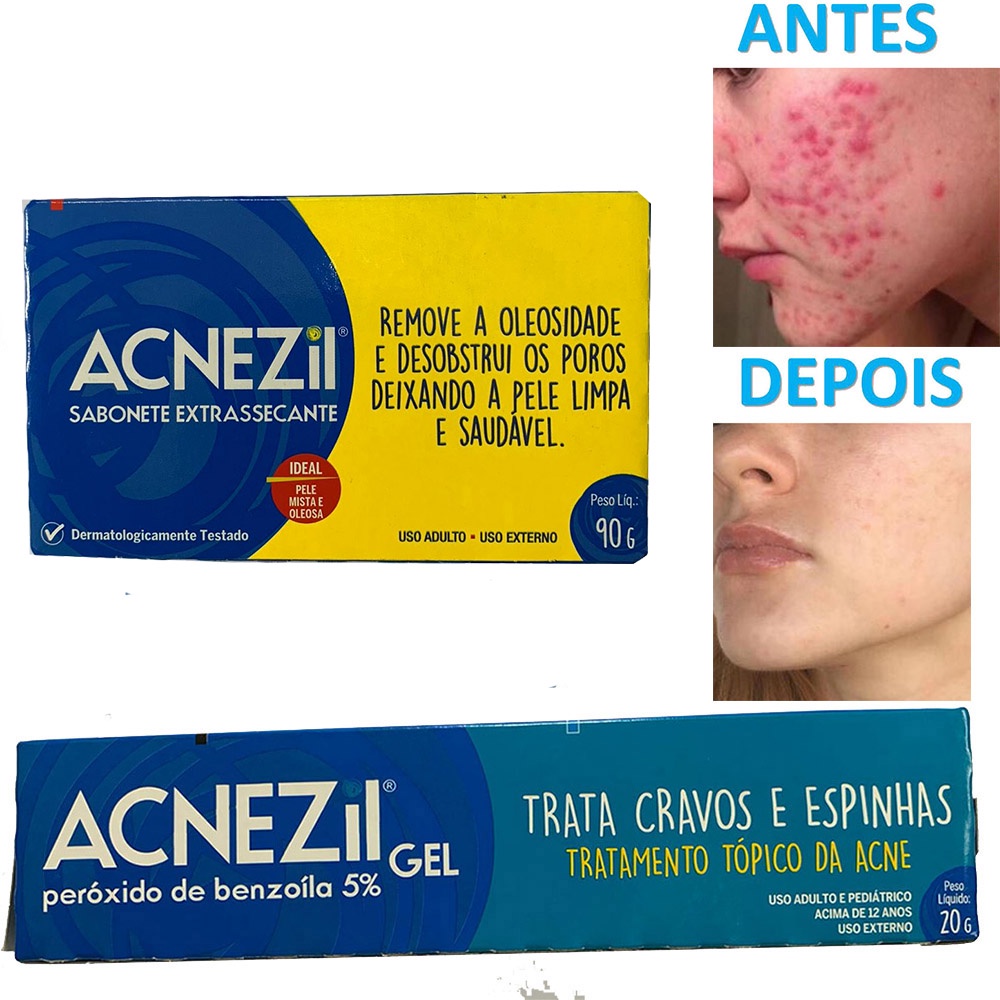 Kit Anti Acne Pomada + Sabonete Tratamento Completo para de Acne Elimina Cravos e Espinhas ...