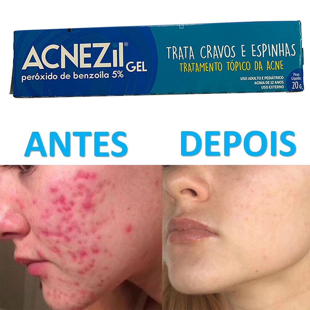 Pomada Creme Acnezil Gel 20g Tratamento Anti Acne Contra Cravos e ...