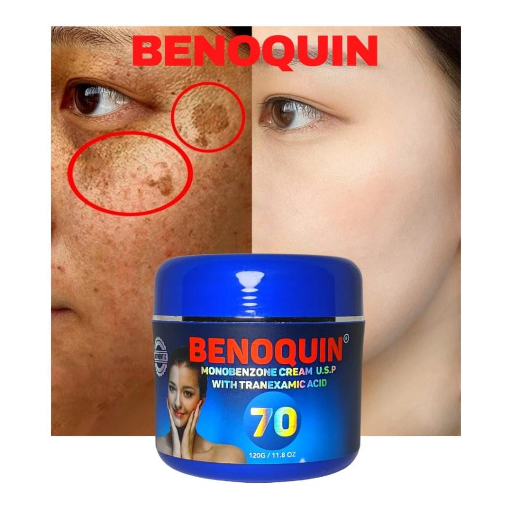 Benoquin Monobenzona Creme 120g Original Impotado | Shopee Brasil