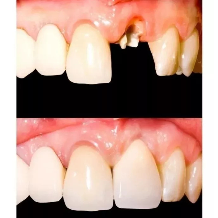 06 COROAS OCAS PARA OS DENTES COR A1 + MASSA FIXADORA ( BOLINHAS ...