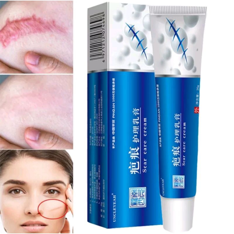 Creme para remover cicatrizes, acne, queimaduras, pomada para manchas em geral para todo corpo ...