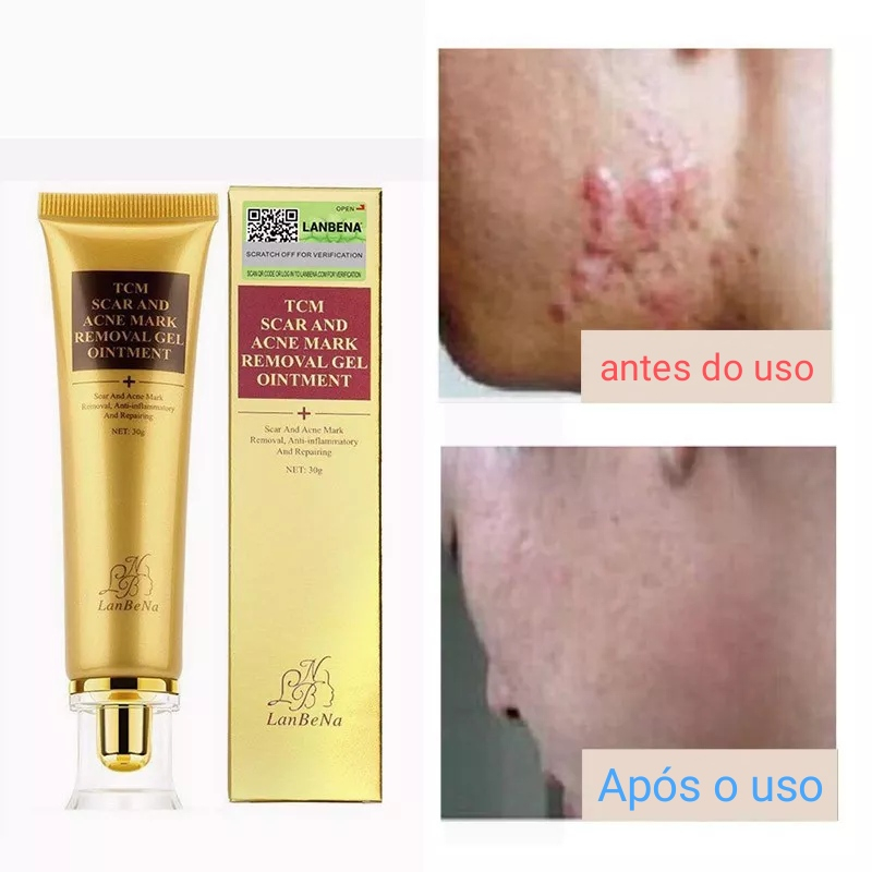 LANBENA Creme Removedor de Cicatriz / Marcas de Espinhas Acnes Estrias Cravos Manchas Machucados ...