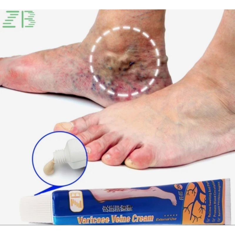 pomada tratamento de varizes vasculares alívio de dor | Shopee Brasil