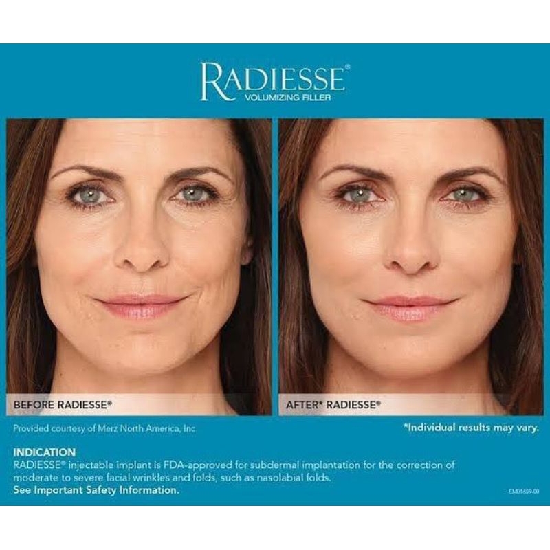 Bioestimulador de Colágeno Radiesse Duo | Shopee Brasil