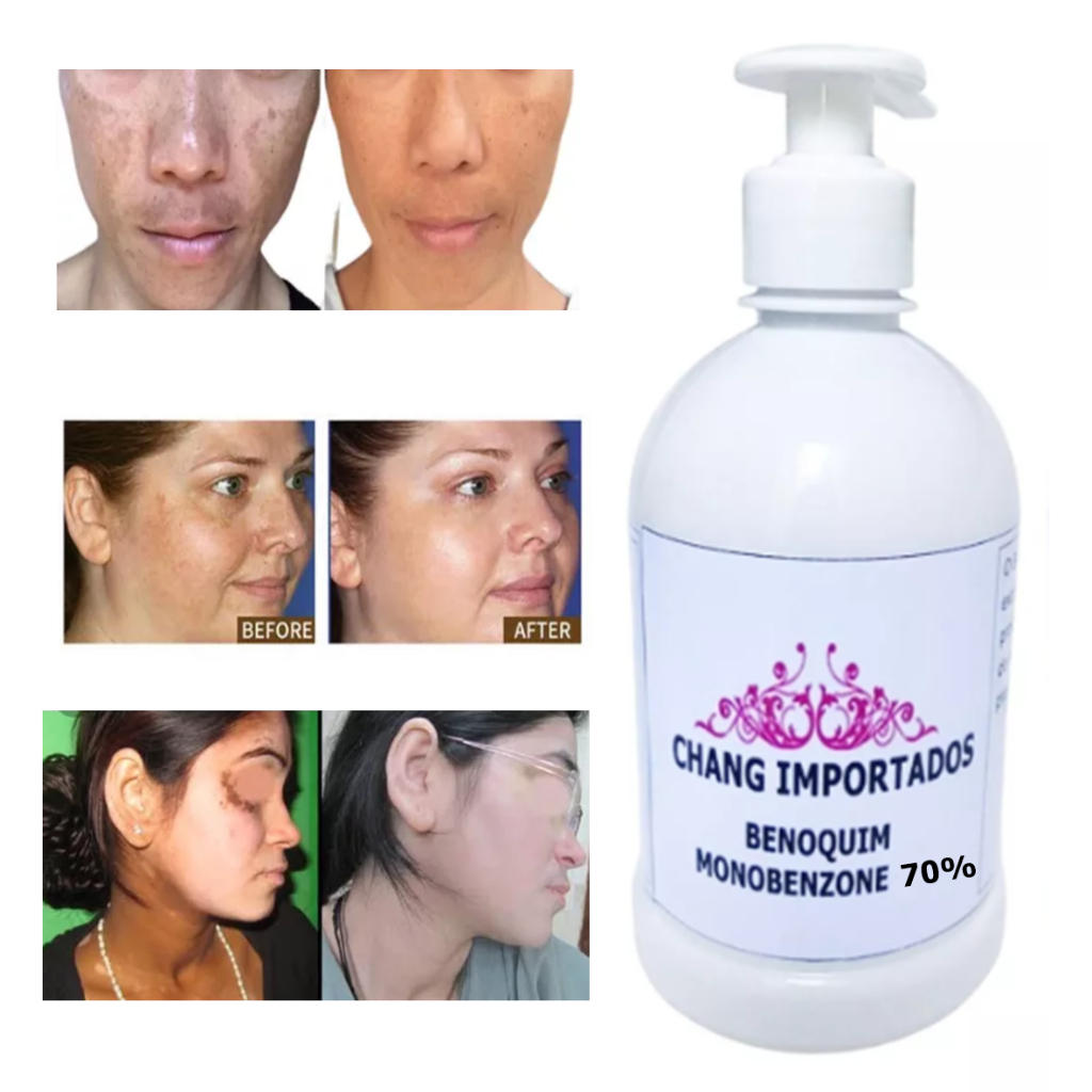 Benoquin Monobenzona 70% Creme Clareador 200g | Shopee Brasil