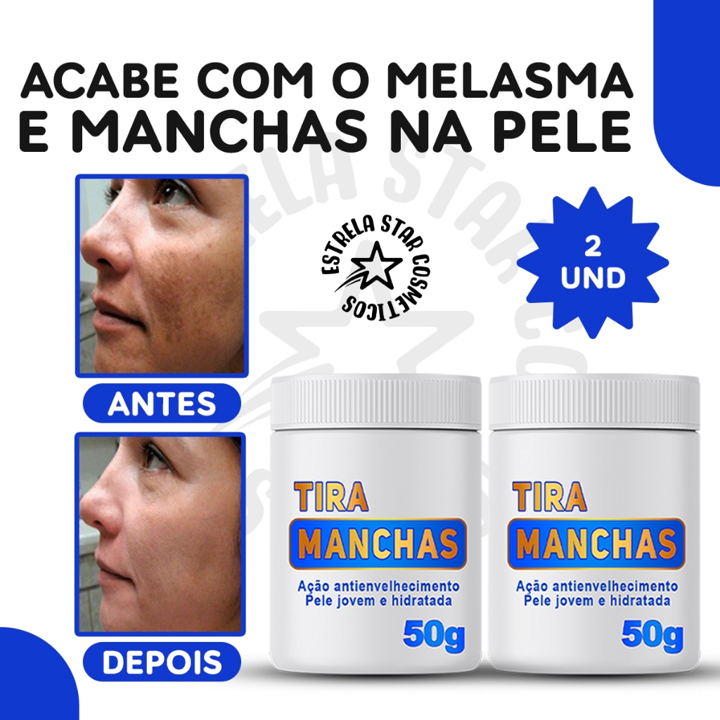Kit 2 Pomada Clareadora Tira Manchas Acne ,Espinhas, Melasma e Linhas ...