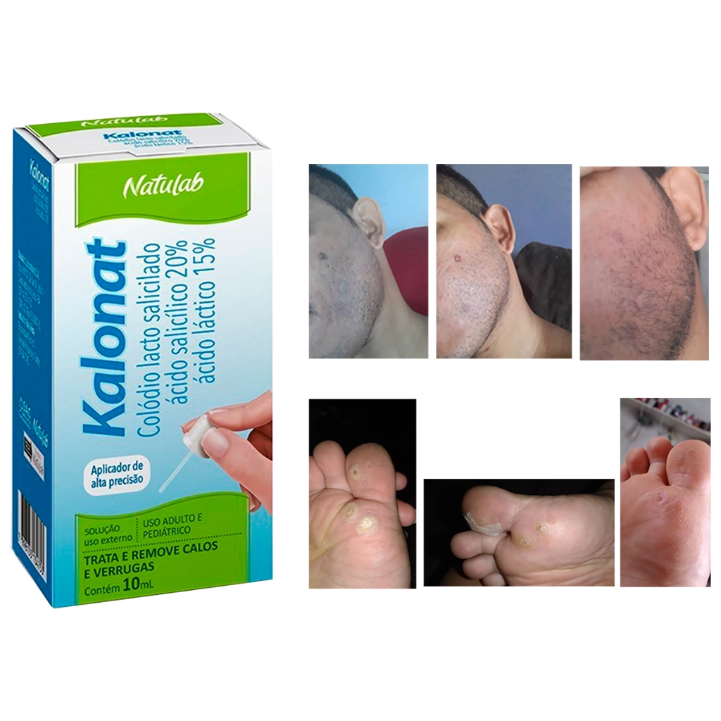 Removedor de Calos e Verruga Líquido com Aplicador 10ml | Shopee Brasil
