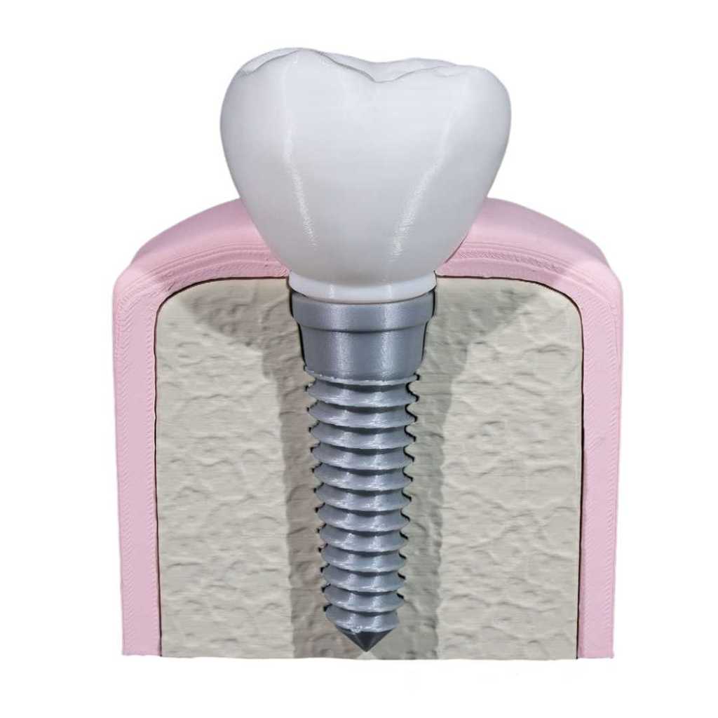 Modelo Anatômico de Implante Dentário Decoração Dentista Dente | Shopee ...