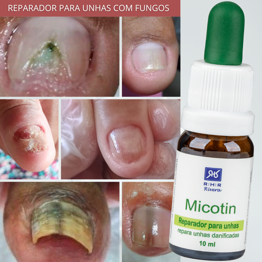 Micose de Unhas Micotin 10ml Conta Gotas - Reparador Para Unhas Com ...