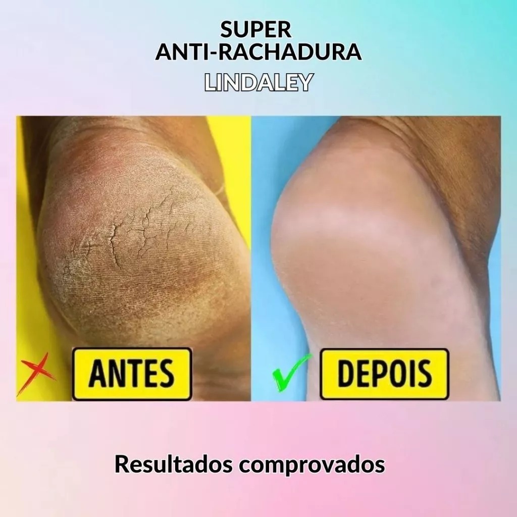 Super Anti-Rachadura do Calcanhar Lindaley Calcanhar Liso e Suave ...