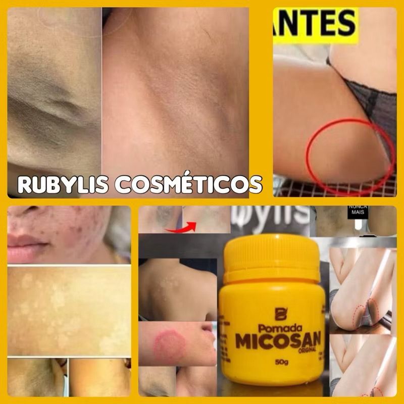 Pomada Micosan Original Para Micoses E Clareador | Shopee Brasil