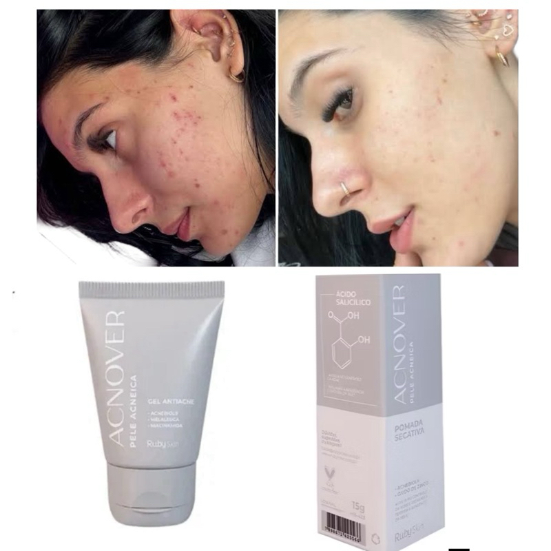 Pomada Secativa Antiacne comtra espinha hidratante Acnover Ruby Rose ...