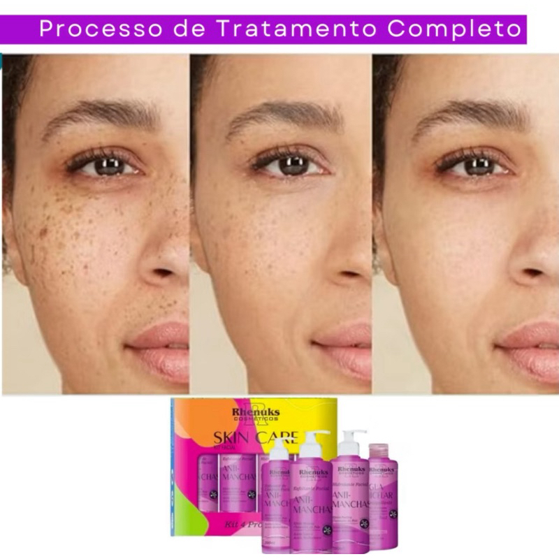 Skin Care Facial anti-manchas de Melasma e de Espinha Limpeza de Pele ...