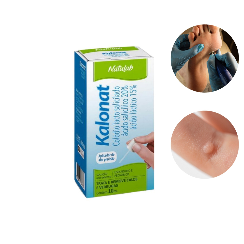 Kalonat Calicida Calos e Verrugas 10mL | Shopee Brasil