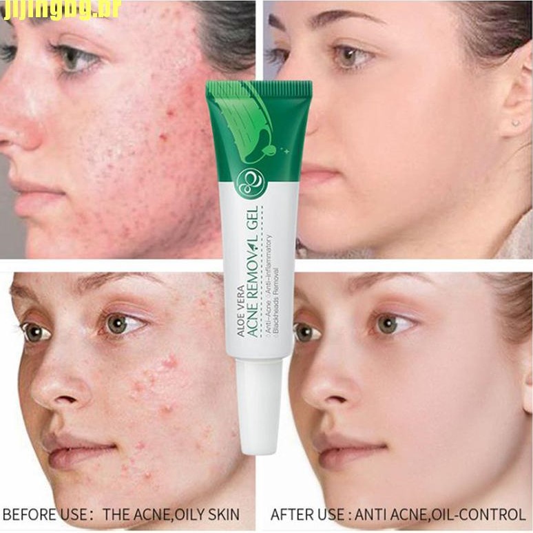 Pomada Gel Tira Manchas e Espinhas Tratamento Acne Aloe Vera | Shopee Brasil
