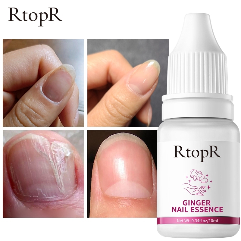 RtopR Gengibre Tratamento Antibacteriano De Unhas Anti Onicomicose ...