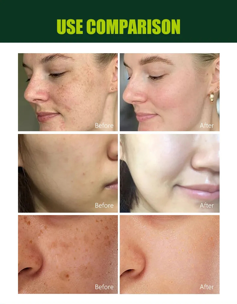 ((Pacote De 2) FEIQUE Creme clareador para remoção de sardas com ...