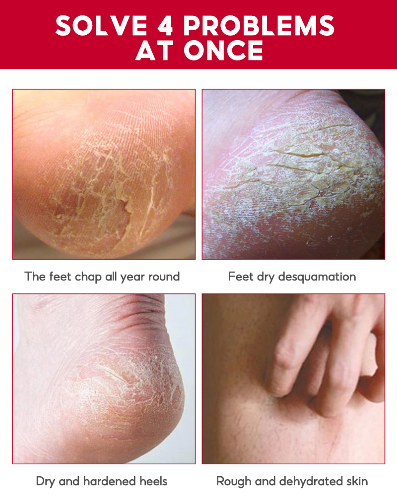 Ruoall Removedor De Calos Secos Para Calcanhar 200ml/Hidratante Pés ...