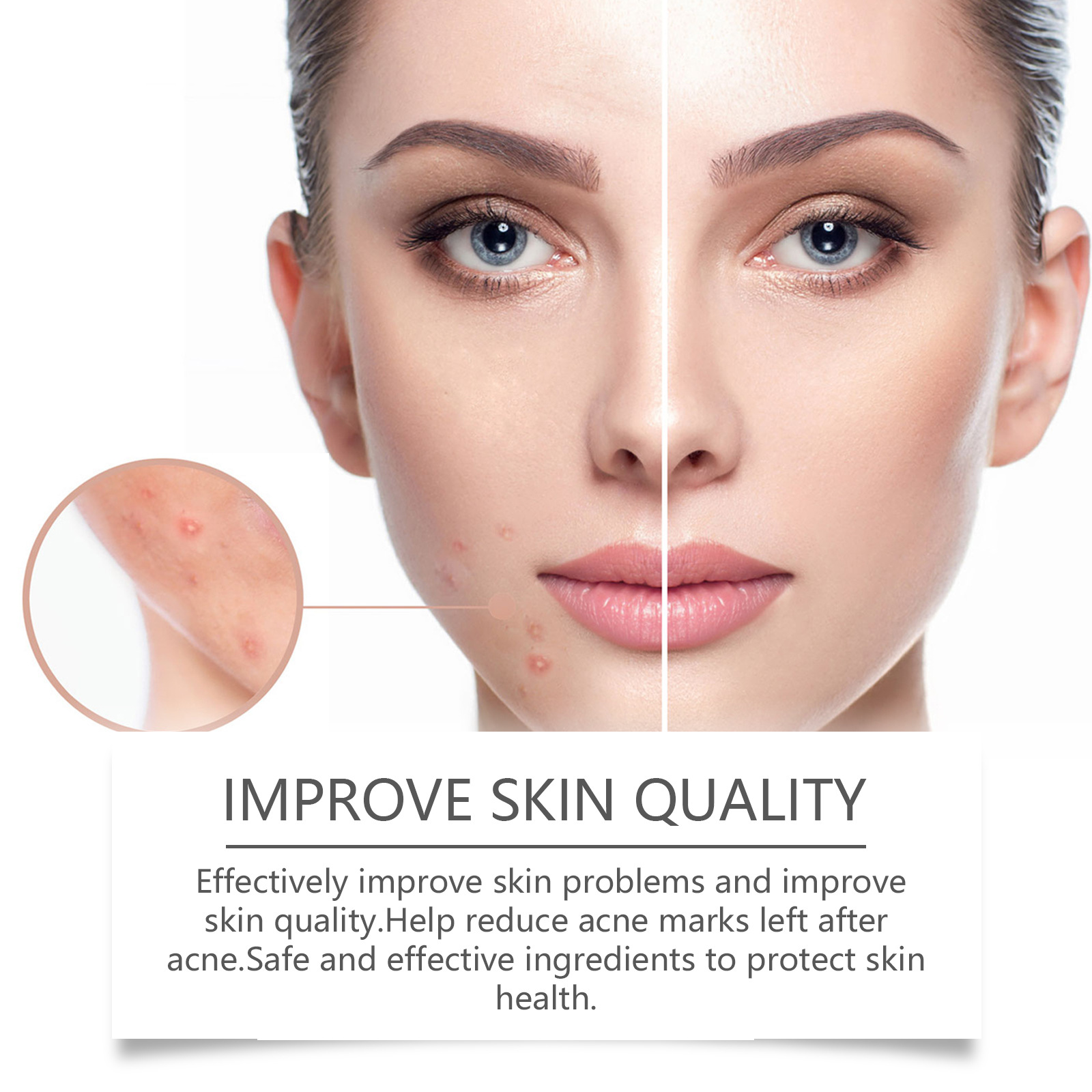 72 Unidades De Adesivos Para Espinhas Rosto , Hidrocolóides Acne E ...