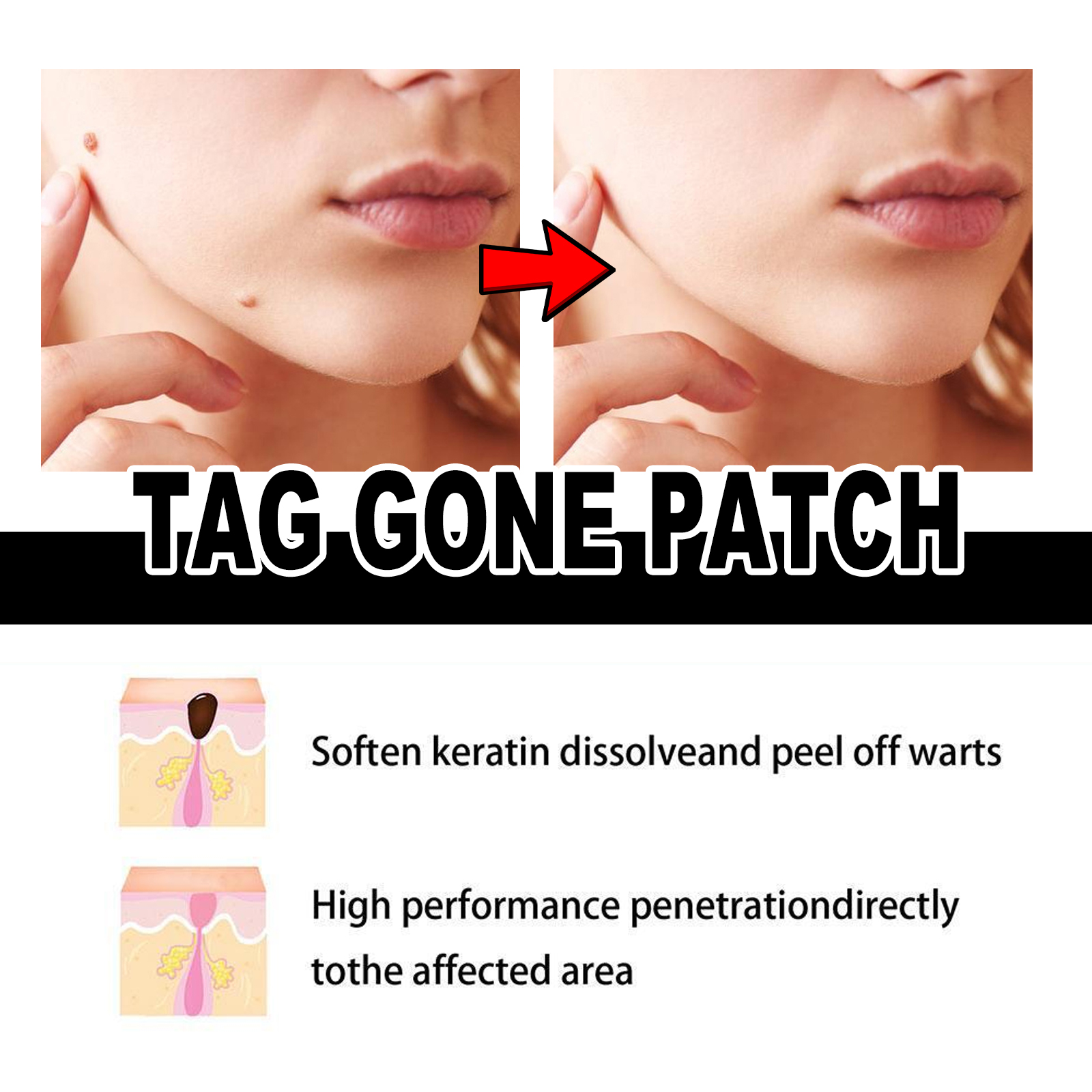 OUHOE Compre 1 TAKE 2 Wart Patch Pimple Patches Acne Tratamentos ...