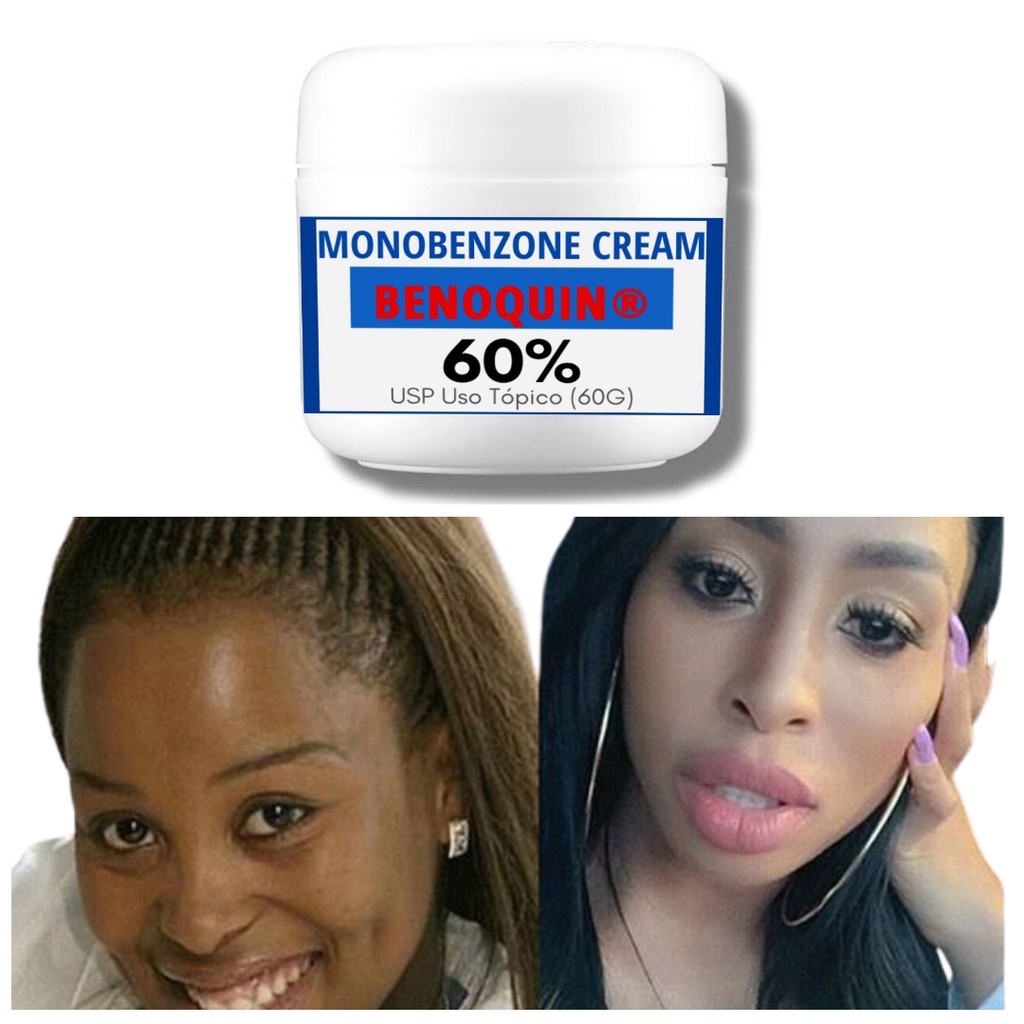 5 und Benoquin 60% Monobenzona. clareador de mancha no rosto de ...