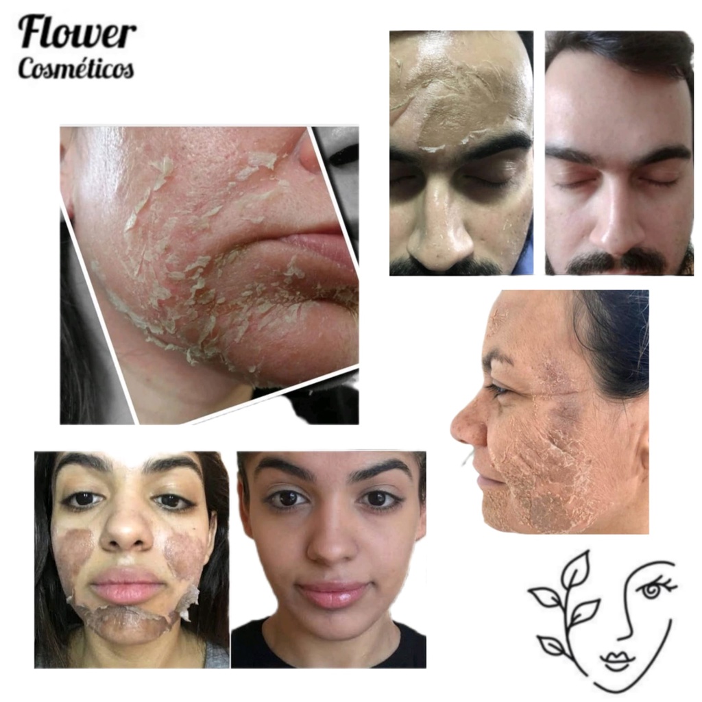Peeling 3D 40% - Peeling Facial Reconstrução da sua Pele - 20ml ...