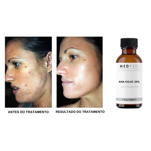 Ácido Kójico Original AHA Kójico 30% Medpeel Peeling Contra Melasma e ...