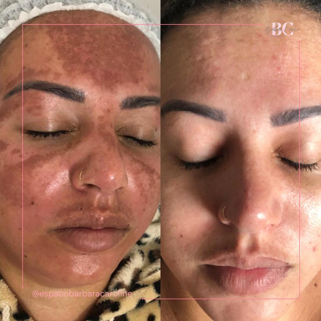 Peeling Clear Peel - Clareador de manchas | Shopee Brasil