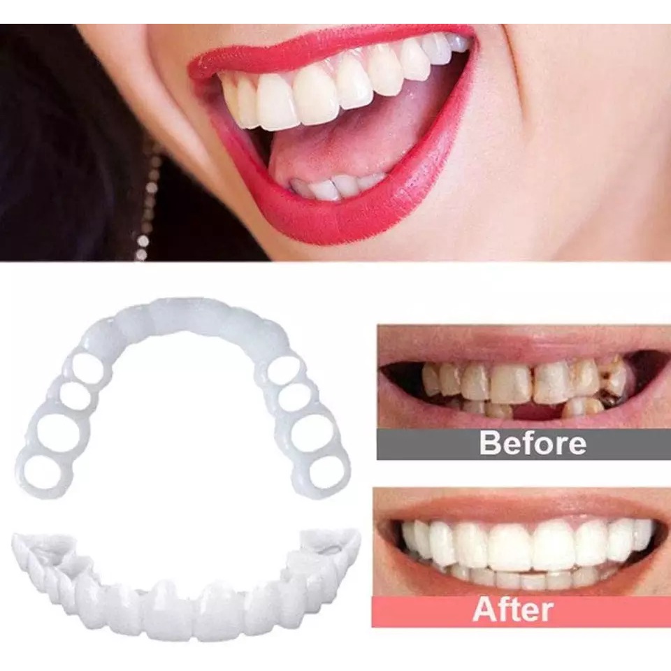 Snap ON SMILE PREMIUM instalar no sorriso (Par) protese superior e ...