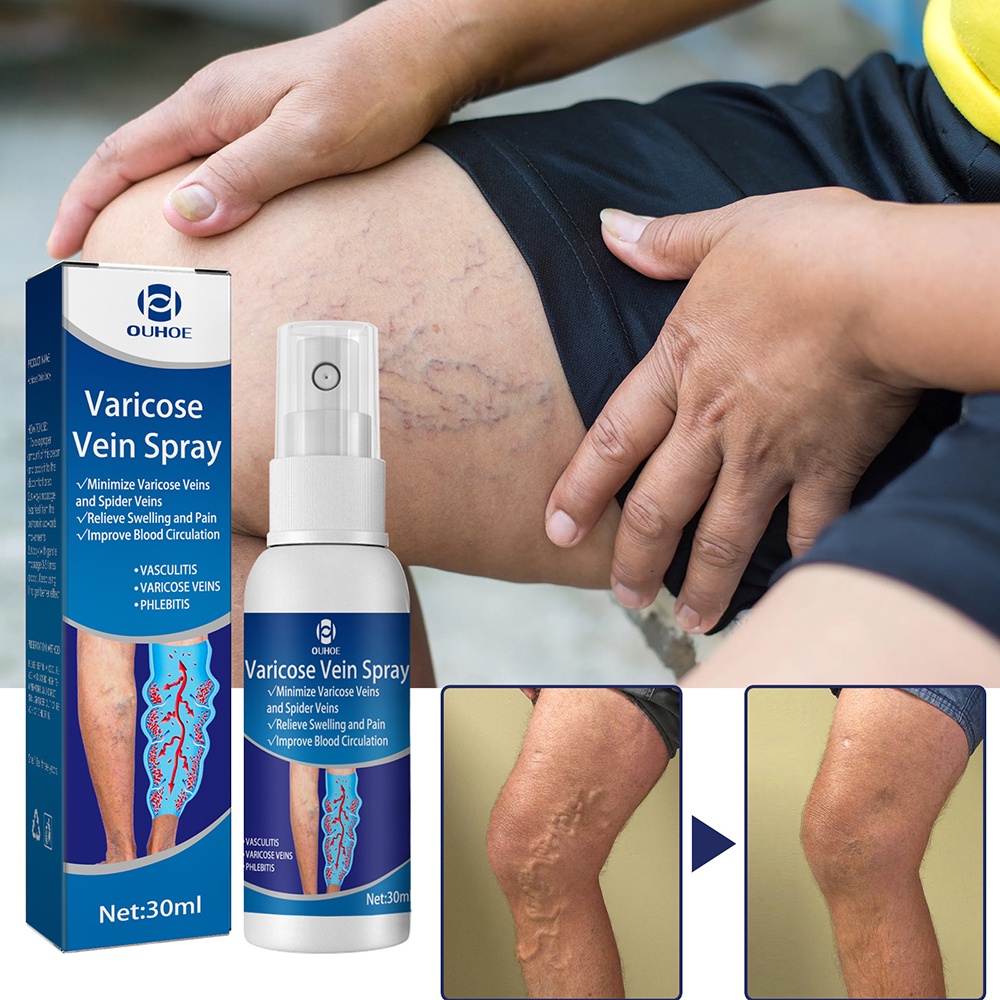 Varizes Massagem De Véias Spray Removedor Tratamento Vasculite Angiite ...