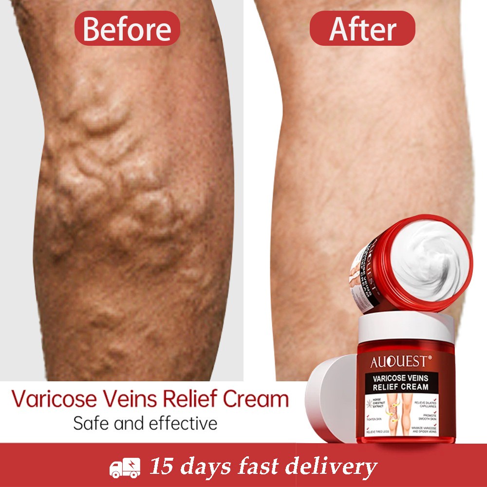 Varicose Creme De Alívio De Véias Vasculite Phlebitis Da Dor Aranha ...