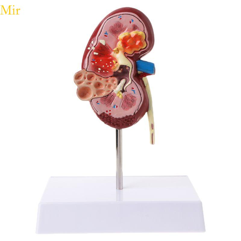Mir Life Size Anatomia Anatômica Do Modelo Rim Doençado Patológico S ...