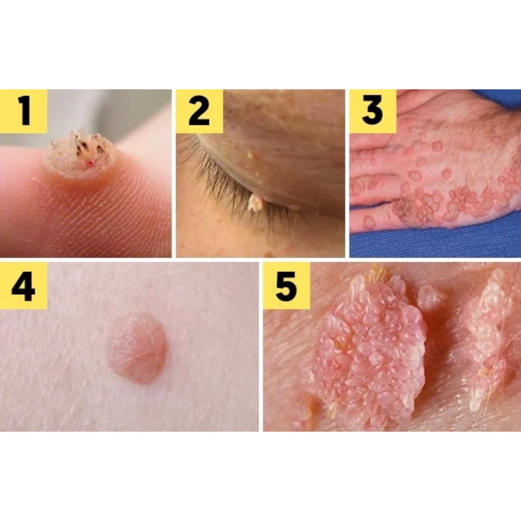 Removedor de verrugas herpes TCA ATA ácido tricloroacético 100%, remove verrugas e HPV | Shopee ...