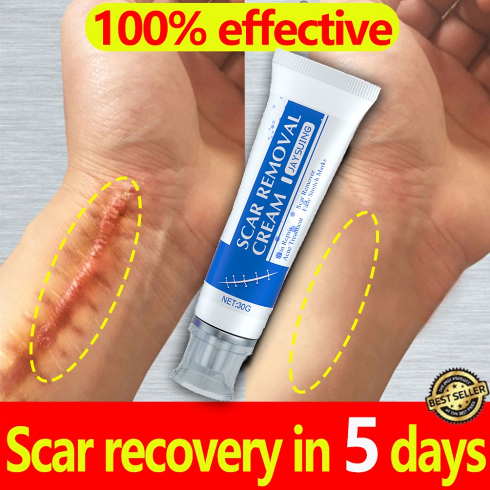 Removedor de cicatrizes Para Perna Velha Gel Marcas Originais Acne ...