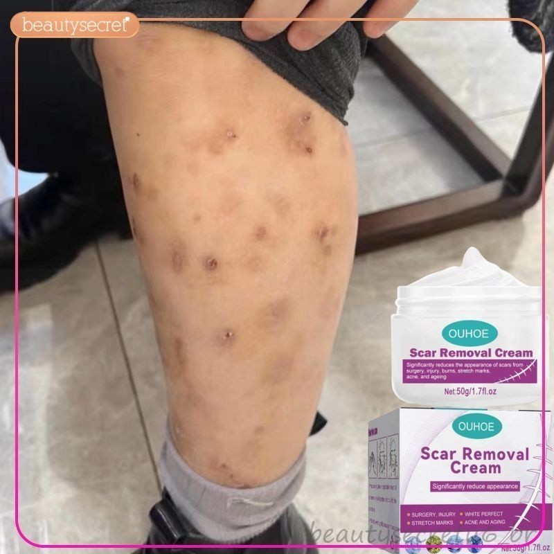 Creme Para Queimaduras E Cicatrizes Pretas Remover Feridas Picada de ...