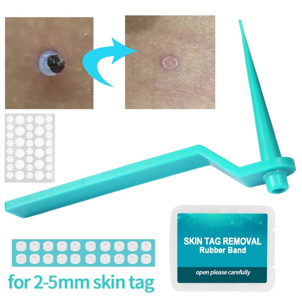 Micro Skin Tag Removedor De Verruga Band Mole | Shopee Brasil