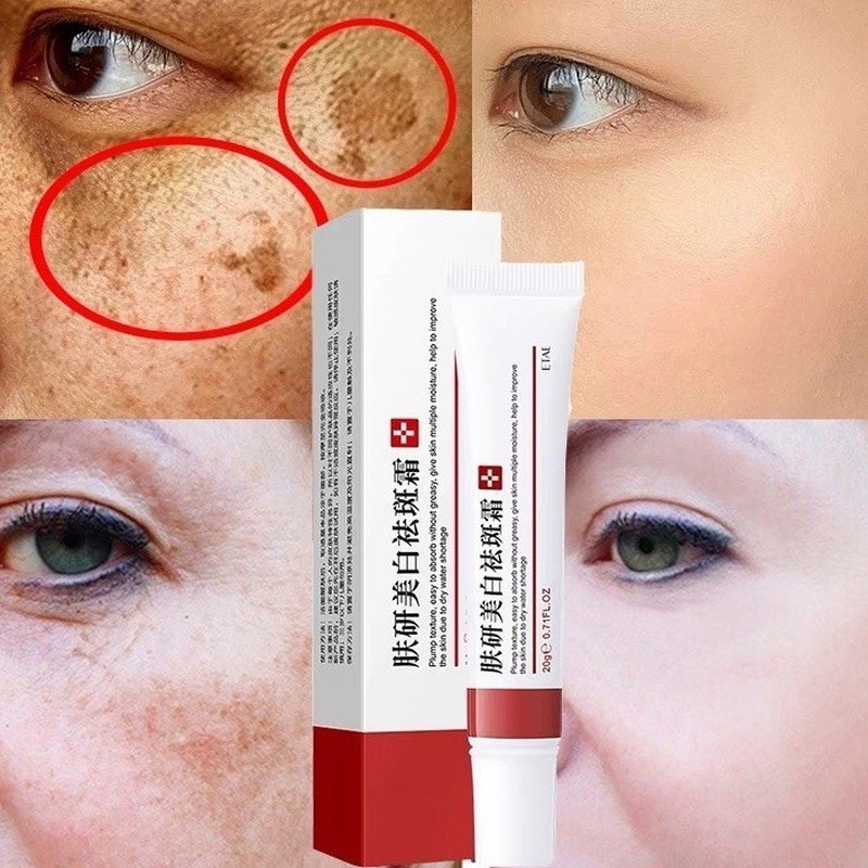 Creme Clareamento Para, Remove a Melanina, Remove o Melasma, Pele ...