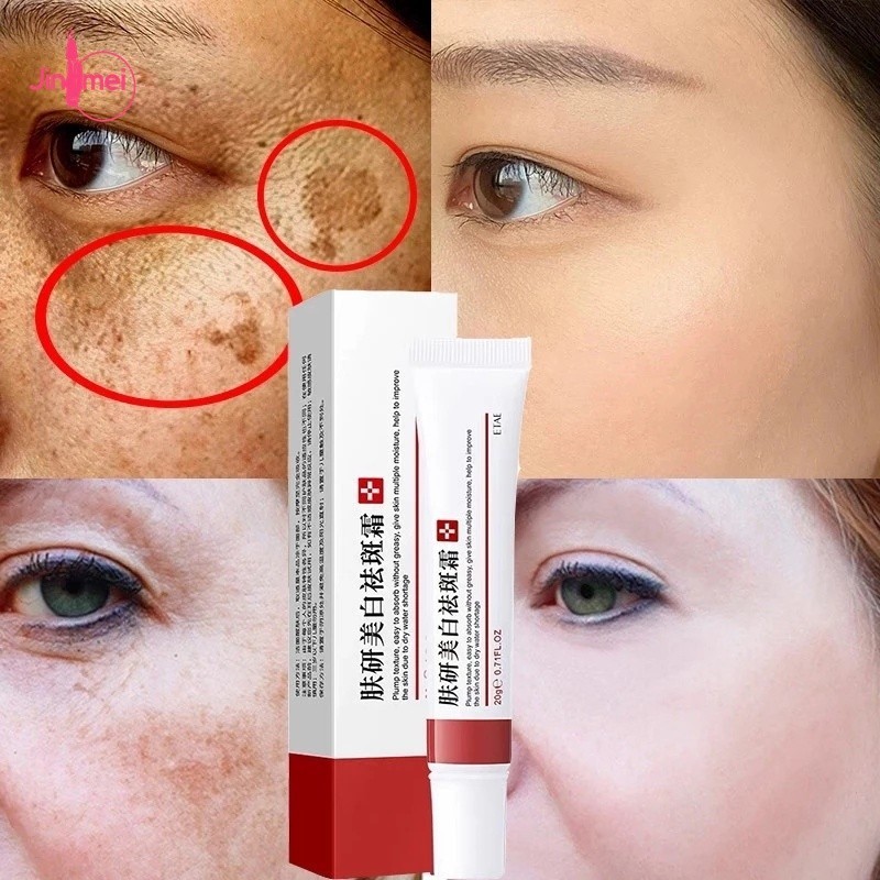 Branqueamento creme para remover melasma manchas escuras, melanina ...