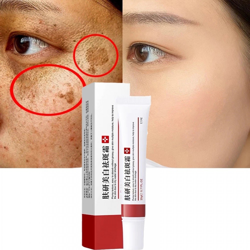 Creme Clareador Para Remover Melasma Remove Manchas Escuras Remove