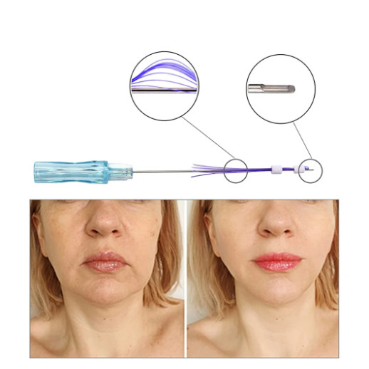 FIO de PDO UVERLA PCL/Multi Thread L Tipo Linha de Risco Face Filler ...