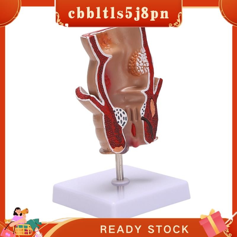 Modelo De Anatomia Para Hemorróidas Retais Humanas , Lesão De ...