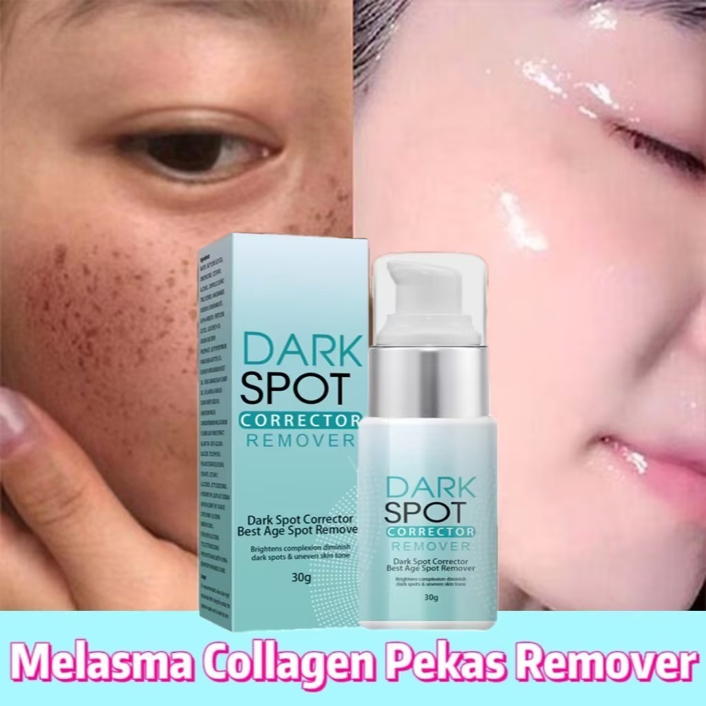 Facial Removedor De Manchas Escuras Creme Branqueador De Sardas Melasma ...
