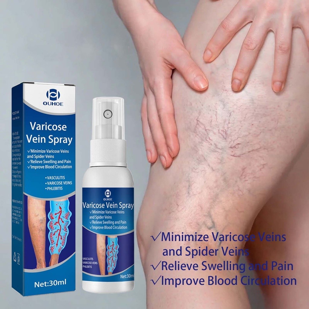 Chibel 30ml Spray De Varizes De Cura Para Pernas Minimizar O Inchaço ...