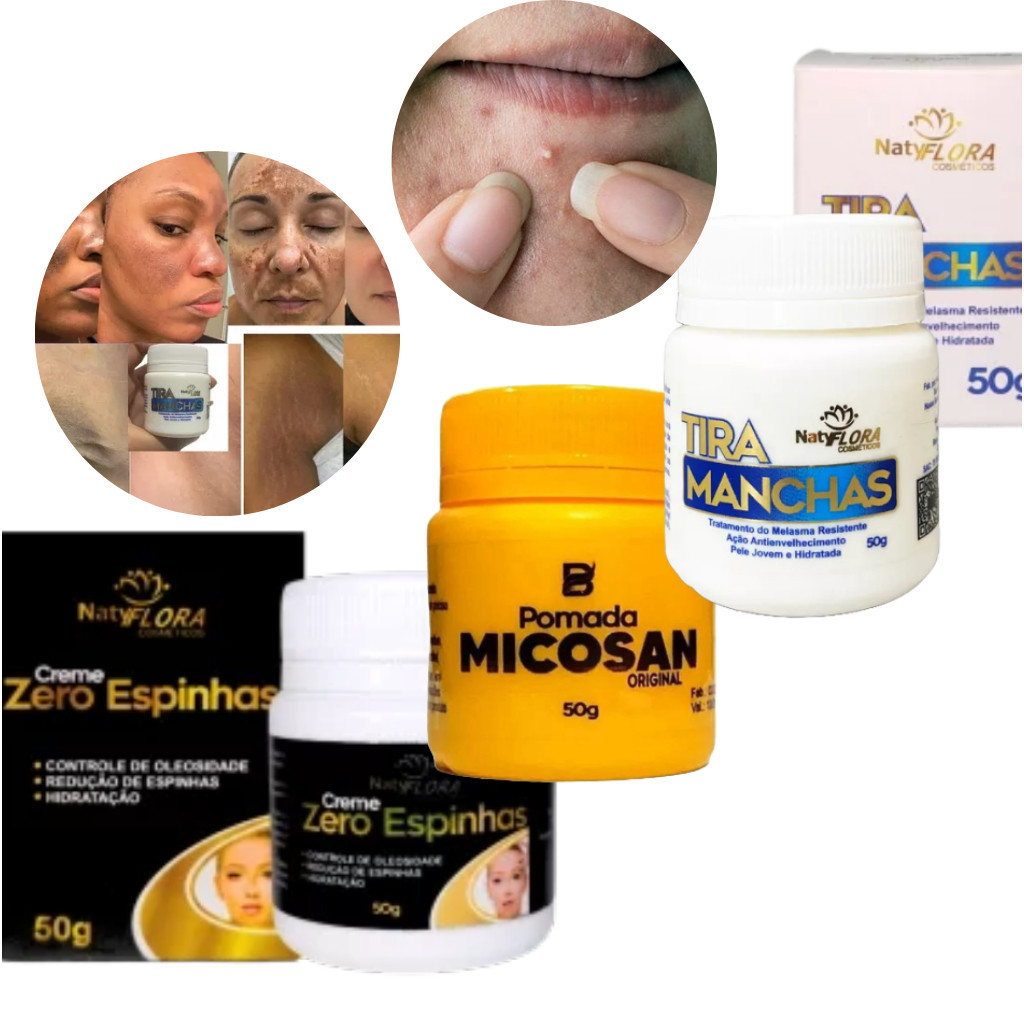 Kit Pomada Tira Mancha + Creme Zero Espinha + Pomada Micosan | Shopee ...