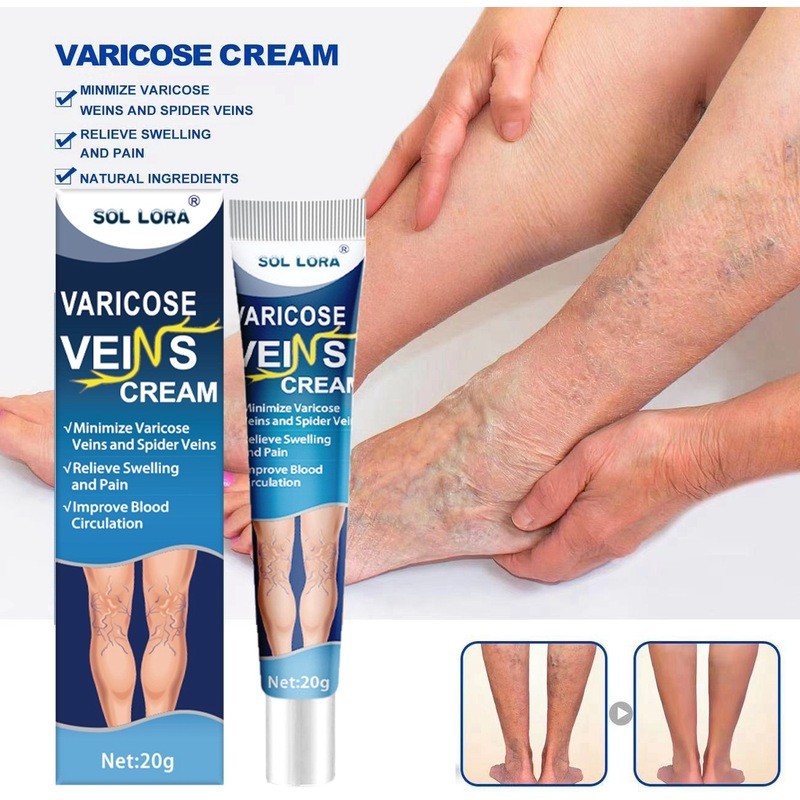 SOL LORA Blue Veia Creme Veia Lishu Pomada Minhoca Creme para Pernas ...