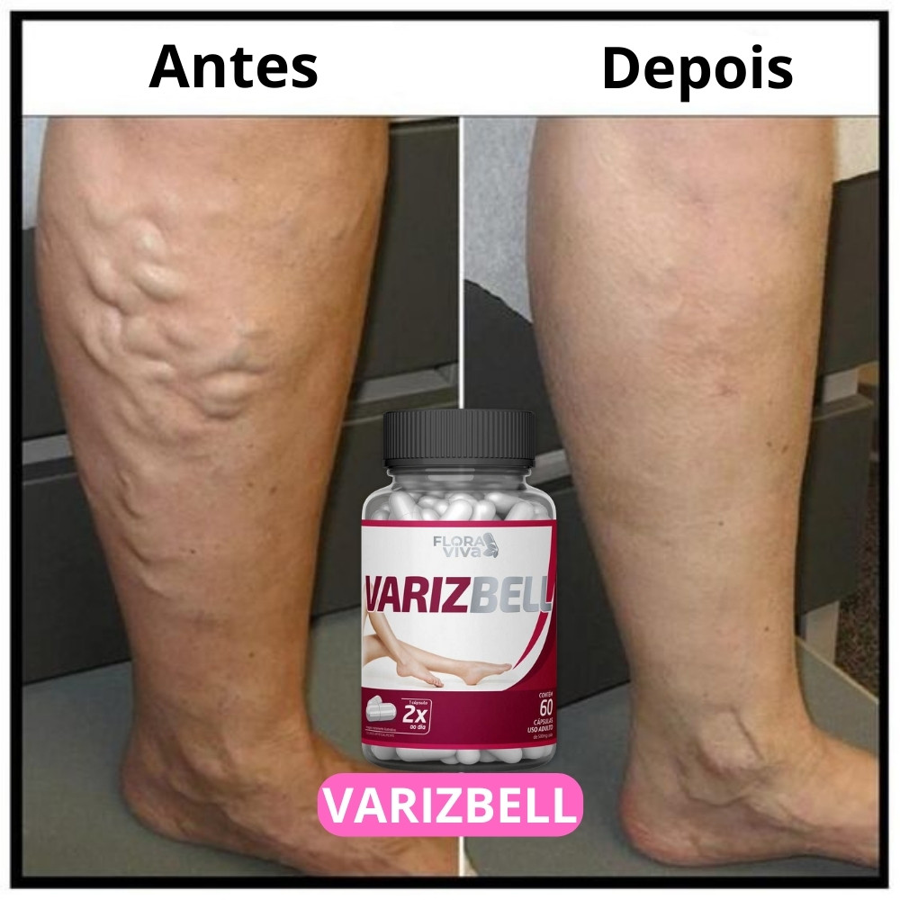 Varizbel Para remover Varizes, Dores e inchaços, Para um bem estar ...